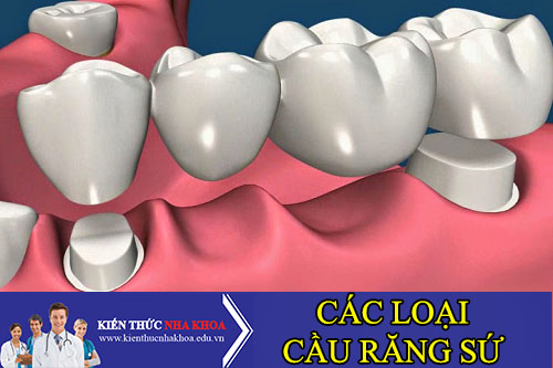 Hiện Nay Có Bao Nhiêu Loại Cầu Răng Sứ?