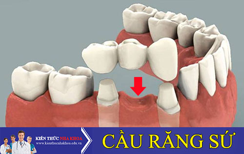 Tổng Quan Những Điều Cần Biết Về Cầu Răng Sứ