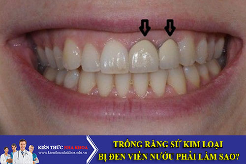 Trồng Răng Sứ Kim Loại Bị Đen Viền Nướu Phải Làm Sao?